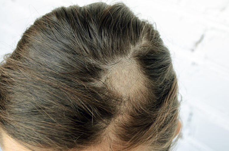 Common Scalp Infections and Hair Loss | Hair Restoration Clinic