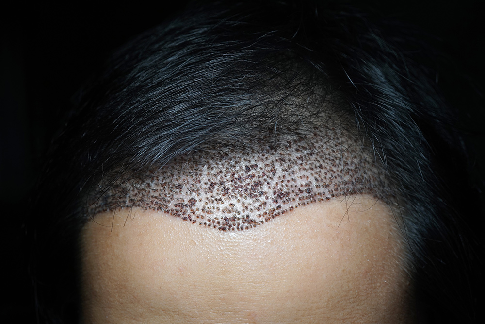 Implanter Pen Hair Transplant Sydney - Hair Doctors